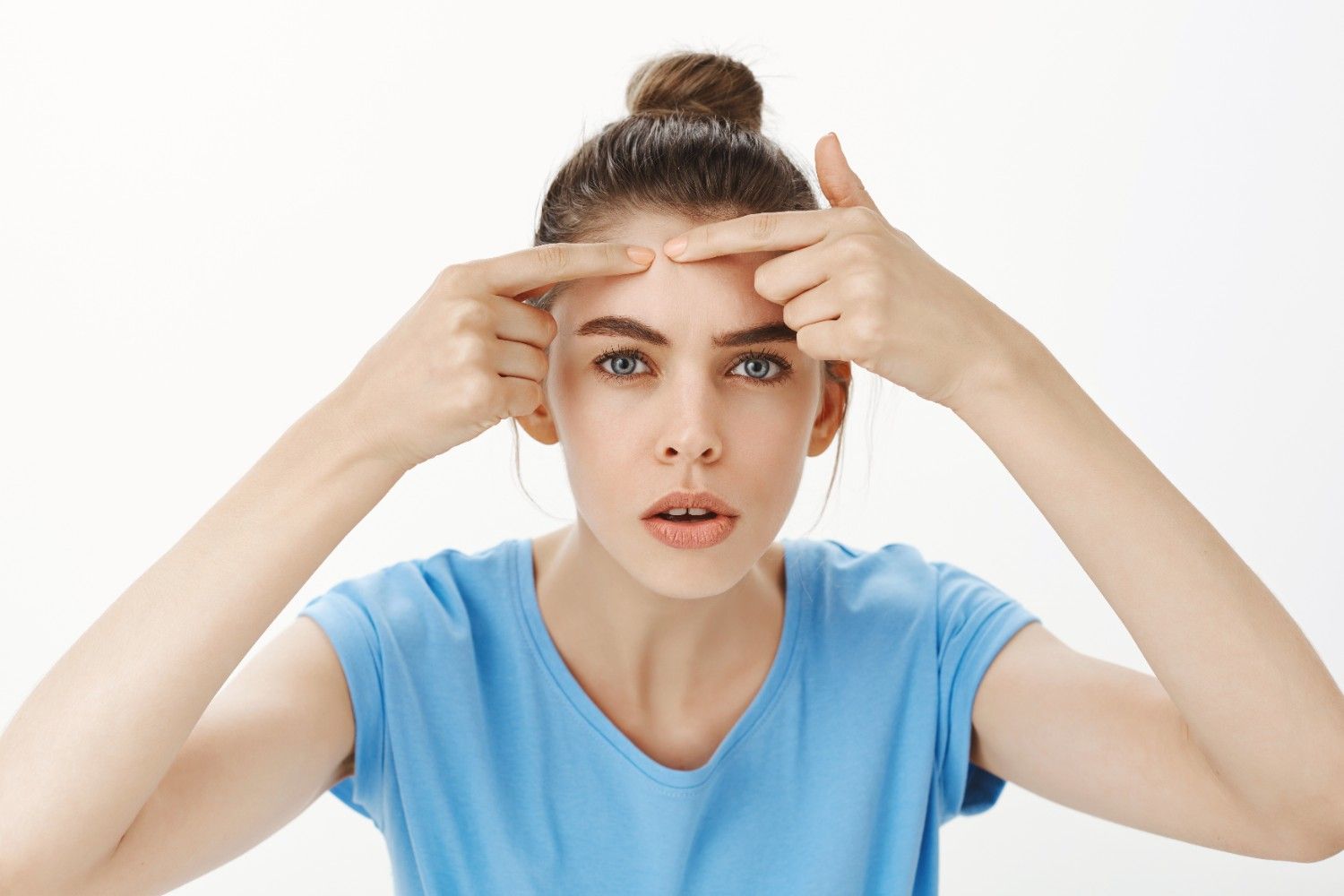 10 Powerful Ways to Get Rid of Forehead Acne Naturally - ShieldMedicalGroup